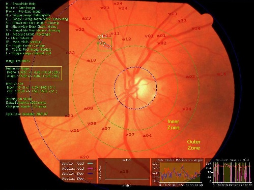Computer-Assisted Methods to Evaluate Retinal Vascular Caliber: What ...